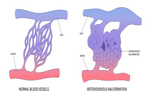 Av Malformation Essential Facts Health Commune