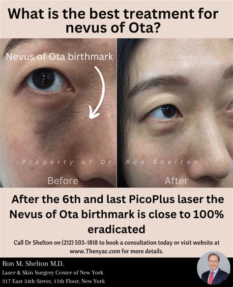 Treatment Of Nevus Of Ota In Nyc Rnyccosmetic