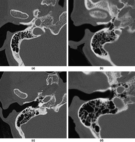 Classification Of Temporal Bone Pneumatization Based On Sigmoid Sinus