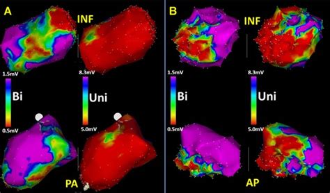 Representative Examples Of Bipolar Bi And Unipolar Uni Endocardial