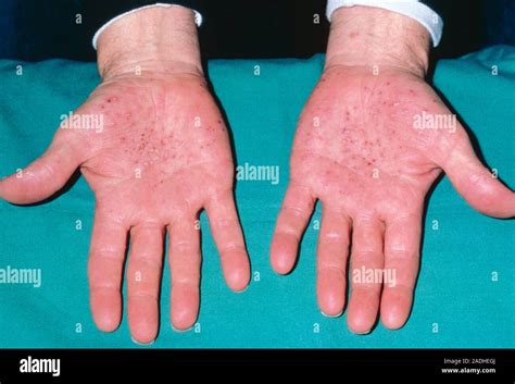 Discoid Eczema Close Up Of The Hands Of A Patient Suffering From