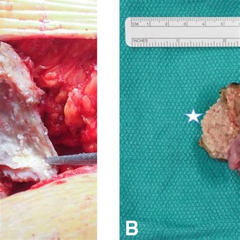 Intraoperative Photographs After Resection Of A Right Atrial Tumor Download Scientific Diagram