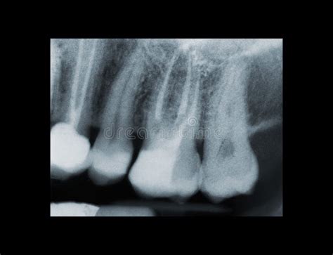 Real X Ray Of Devitalized Tooth X Ray Of Root Canal Treatment Tooth