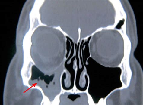 Enophthalmos Definition Causes Symptoms Diagnosis And Treatment