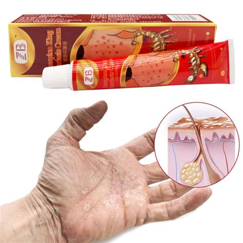 20g Zb Scorpion Venom Essence Paste Skin Psoriasis Cream Dermatitis