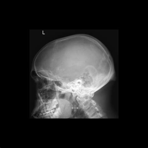 Pediatric External Occipital Protuberance Pediatric Radiology