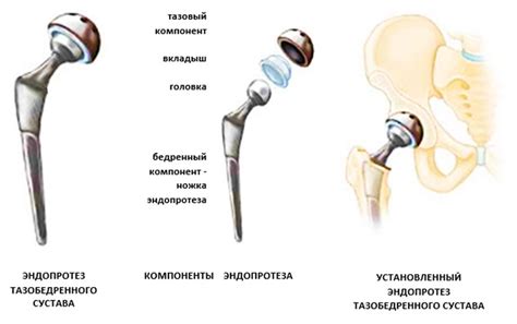 Основные принципы выбора эндопротеза тазобедренного сустава Болезни