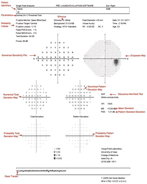 Which Is And Nasal Visual Field Interpretation
