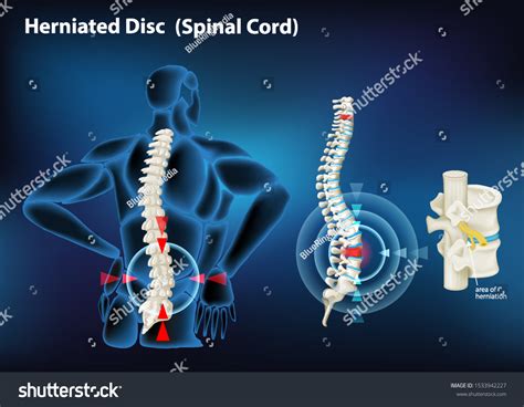 Diagram Showing Herniated Disc Human Illustration стоковая векторная