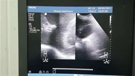 Hepatization Of Gall Bladder Ultrasound Youtube