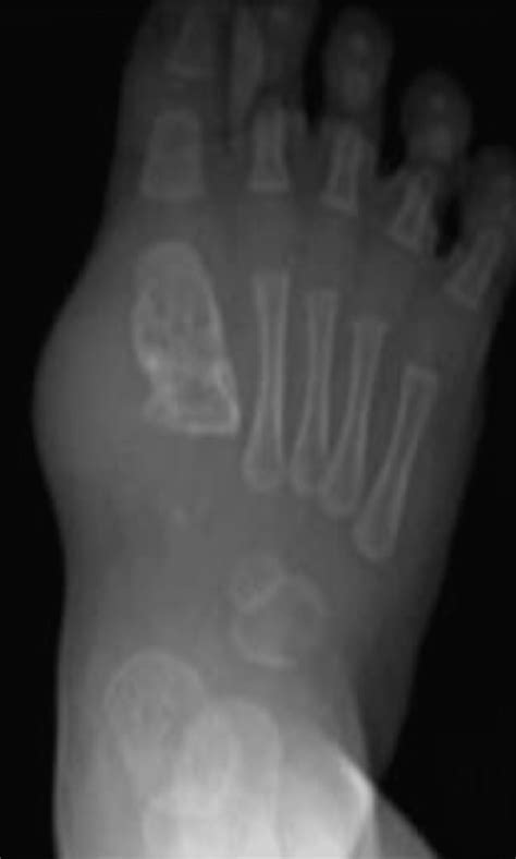 Plain Radiograph Of The Right Foot Showing Soft Tissue Swelling Over