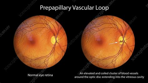 Prepapillary Vascular Loop On The Retina Illustration Stock Image