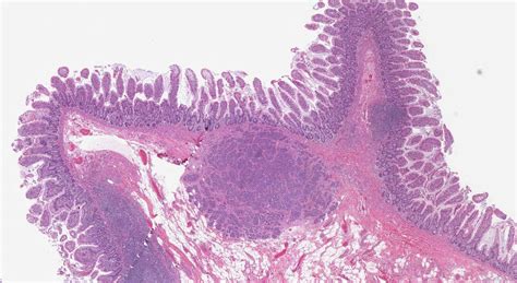 Well Differentiated Neuroendocrine Tumour Of The Small Intestine