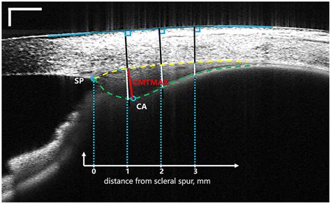 Example Of Ciliary Muscle Segmentation And Measurement Each Pixel Was