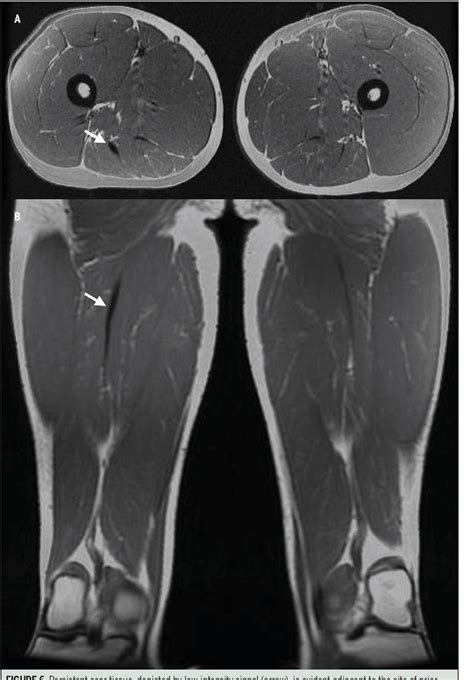 Mri For Hamstring Injury