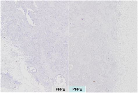 Preanalytix Compare Paxgene Tissue Solutions And Ffpe