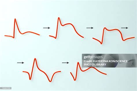 Myocardial Infarction Ecg 2000 Ecg In Myocardial Infarction Stock