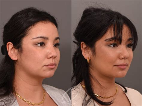 Deep Neck Contouring Before And After Photos Patient 1001548 Serving