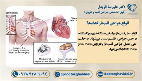عمل قلب باز ضروری‌ترین نکات جراحی قلب باز انواع و مراحل