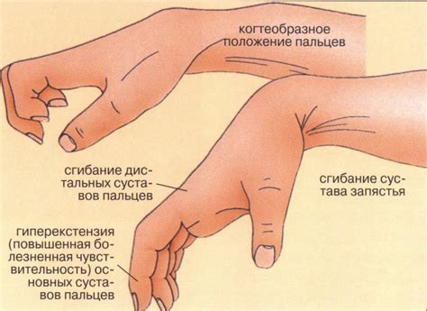 Ischemic contracture of Folkman