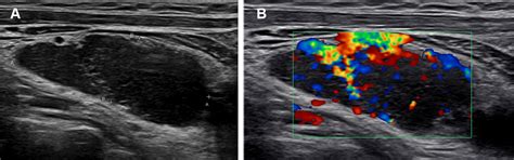 Imaging Of Castleman Disease Radiographics