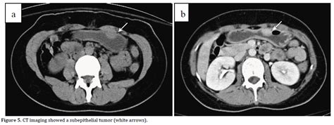 Gastric Ectopic Pancreas Manifested As A Subepithelial Tumor Thr