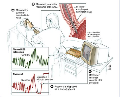 Patient Set Up And Technique Of Manometry Download Scientific Diagram