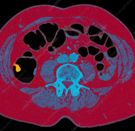 Colorectal Polyp Ct Scan Stock Image C051 8521 Science Photo Library
