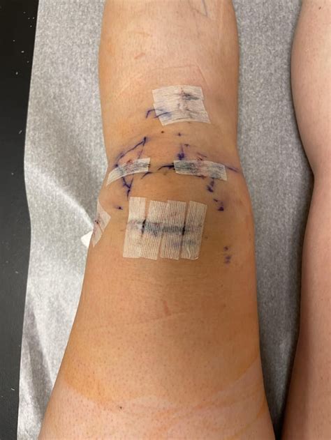 Before And After 1 Day Post Op Acl Revision Racl