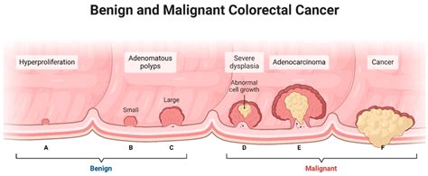 Conventional Adenoma Carcinoma Sequence Pathway Of Colorectal Cancer Download Scientific