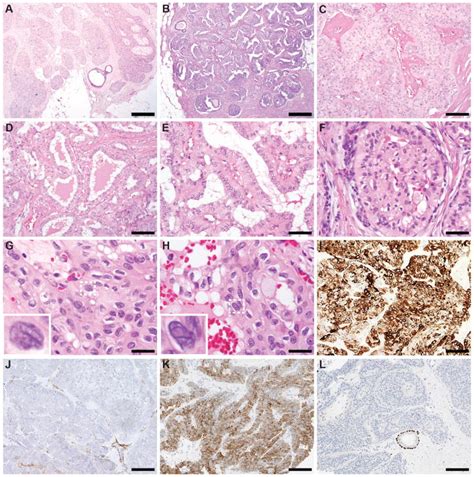 Solid Papillary Breast Carcinomas Resembling The Tall Cell Variant Of