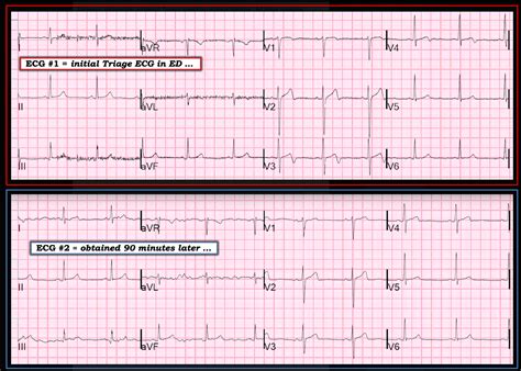 Dynamic Reversible Ischemic T Wave Inversion Mimics Wellens All