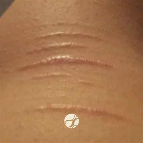 Linear Scar Lines The Scar Clinic Perth