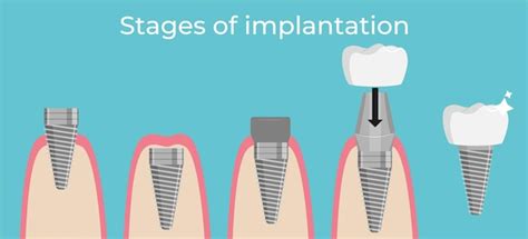 Les étapes De La Pose Dun Implant Dentaire Illustration Vectorielle
