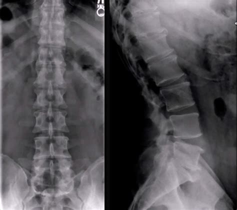 Frontiers Complete Lumbarization With Calcified Disc 46 Off