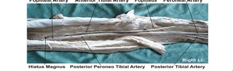 Photographic Presentation Of The Right Popliteal Artery Terminating Download Scientific Diagram