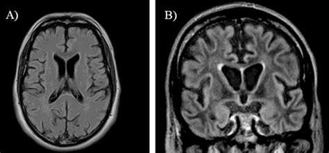 Figure 4 From Autosomal Dominant Frontotemporal Lobar Degeneration Due