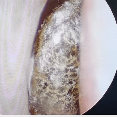 Rigid Nasal Endoscopy Revealed Eschar In The Middle Turbinate