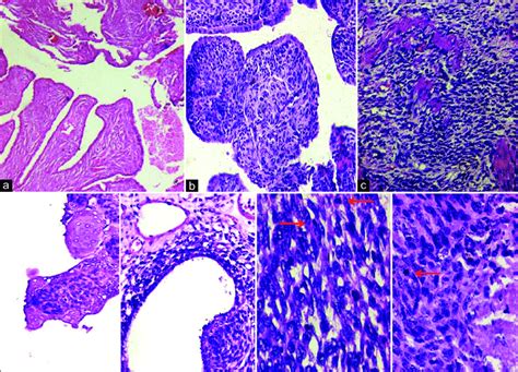Case 16 Polypoid Lesion With Benign Epithelial Lining And Spindly