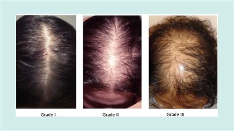 How To Treat Androgenic Alopecia In Females