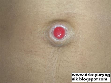 Drkeyur Yagnik Raspberry Tumor