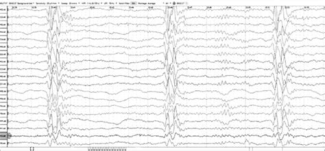 Electroencephalogram An Awake Electroencephalogram International