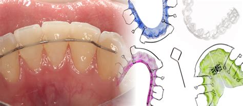 How Long Should I Wear Retainers After Braces Essential Guide