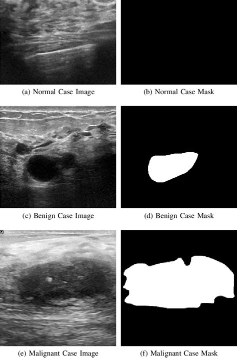 figure 3 from convmixer unet a lightweight network for breast lesion