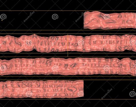 Ct Colonography Or Ct Scan Of Colon Rendering Image Stock Image Image Of Abdomen Digestive