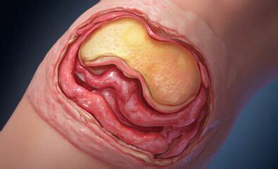 Degloving Injuries Md Searchlight