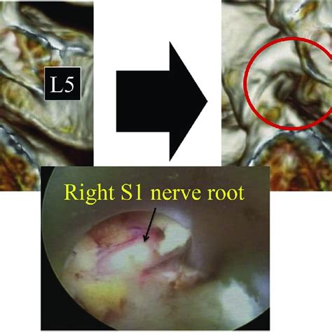 Ct Scan And Mris For A Case Of Hnp At L5 S Mri Indicates The Hnp At