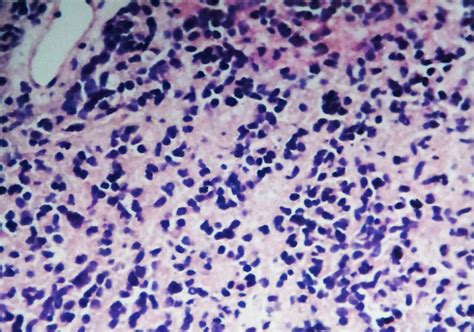 Vulvar Adenocarcinoma Visual Resemblance To A Vulvar Abscess Bmj