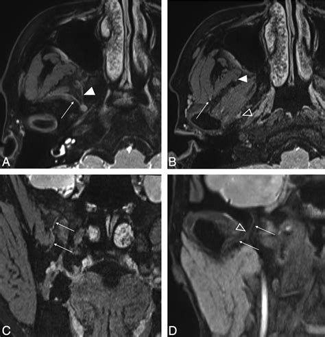 Trigeminal Nerve Mri Sagittal
