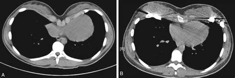 Chest Wall Reconstruction Clinical Tree